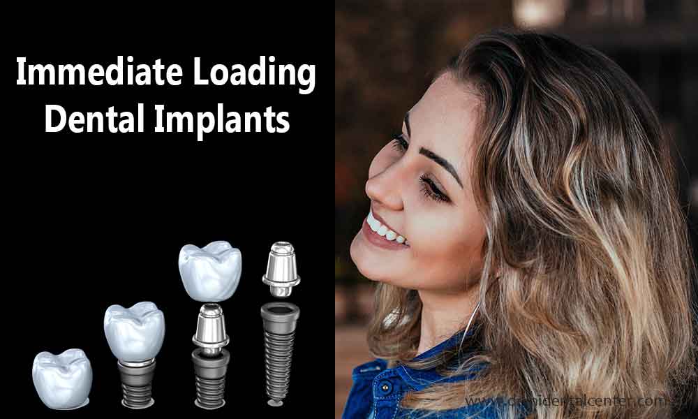 One Day Dental Implants – Who Is a Candidate?