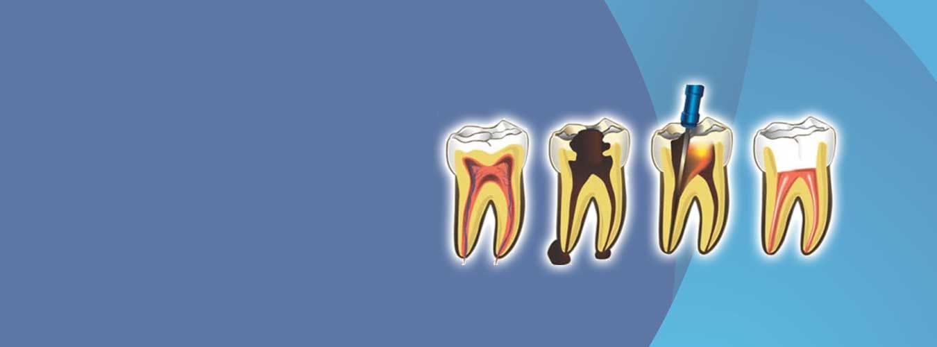 Delhi Dental Center, Dental Implants, Braces and Teeth Whitening in Delhi