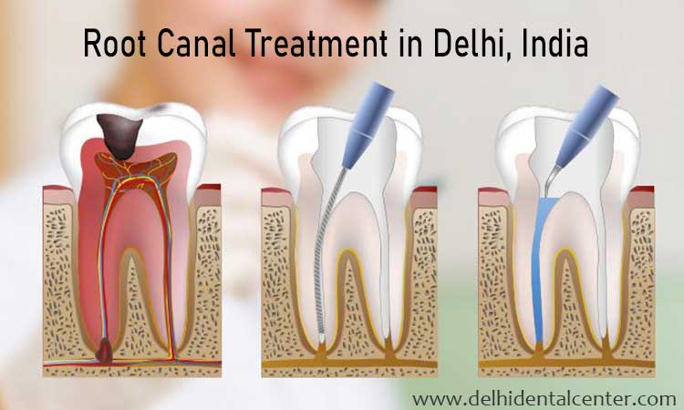 RCT Treatment in Greater Noida - Delhi Dental Center - Dental Implants ...